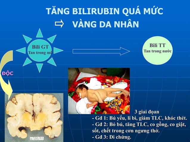 VÀNG DA TĂNG BILIRUBIN GIÁN TIẾP Ở TRẺ SƠ SINH | PDF