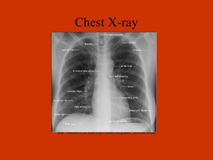 Ventilator Associated Pneumonia