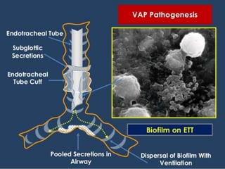 Ventilator Associated Pneumonia Pathophysiology