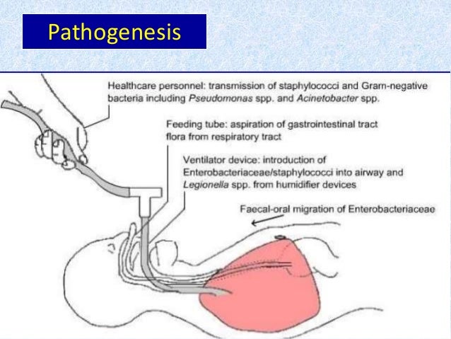 ventilator Associated Pneumonia -By Dr.Tinku Joseph