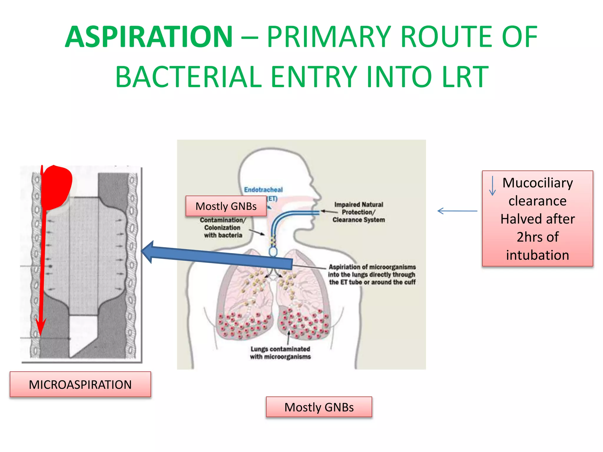 VENTILATOR - ASSOCIATED PNEUMONIA | PPTX