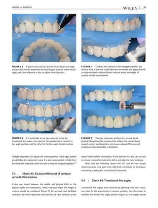 A Systematic Approach to contouring and polishing anterior resin ...