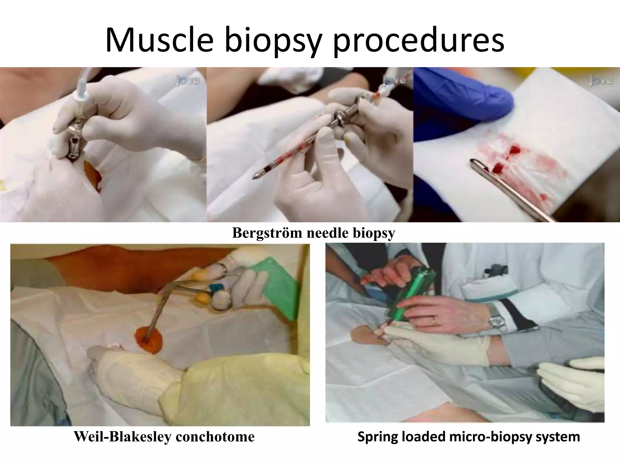 Muscle biopsy | PPTX