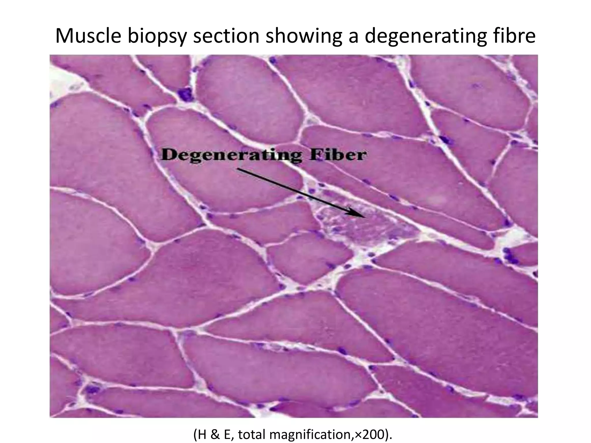 Muscle biopsy | PPTX