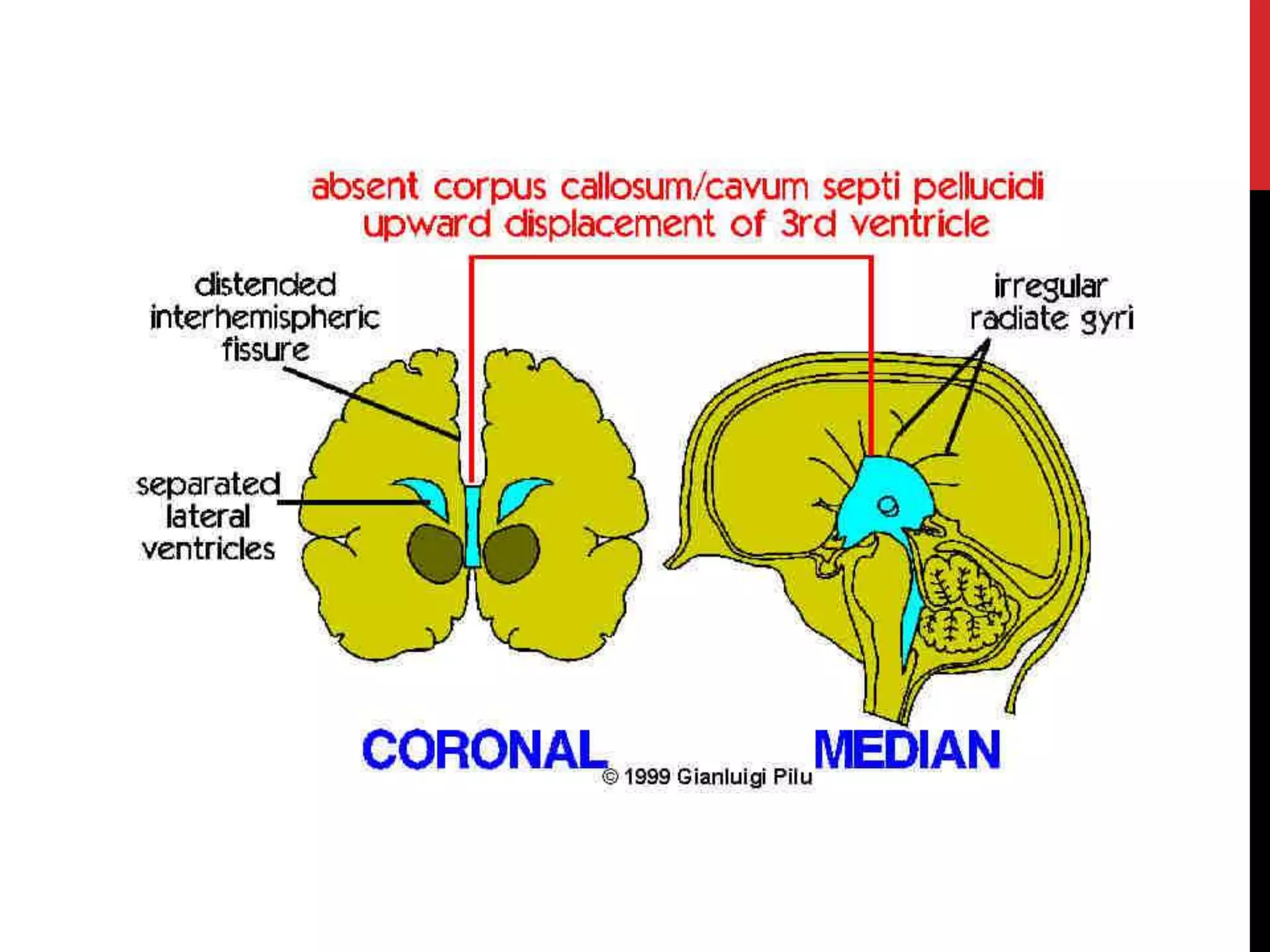 Variantes anatómicas del septum pellucidum | PPTX