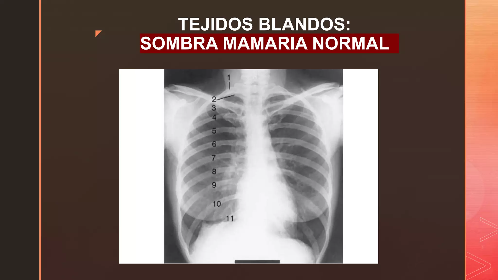 VARIANTES ANATOMICAS DEL TORAX | PPTX