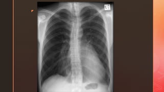 VARIANTES ANATOMICAS DEL TORAX | PPTX