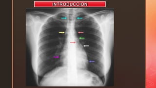 VARIANTES ANATOMICAS DEL TORAX | PPTX
