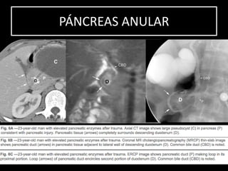 VARIANTES ANATÓMICAS PANCREÁTICAS Y ANOMALÍAS CONGÉNITAS | PPTX