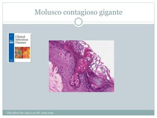 Histología Del Molusco Contagioso