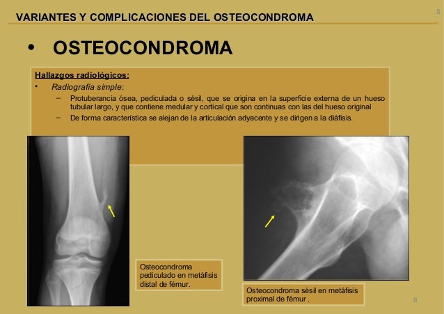 Variantes y complicaciones del osteocondroma