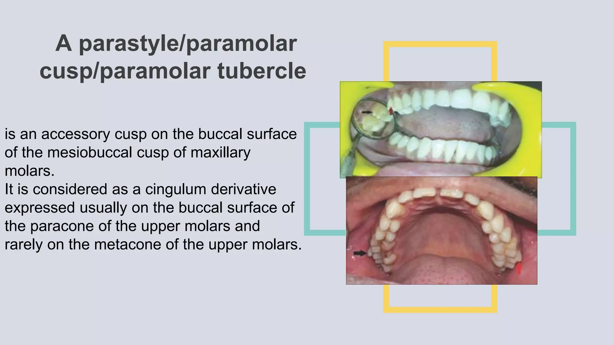 Variation in maxillary molars | PPTX
