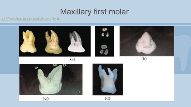 Variation in maxillary molars | PPTX | Dental Health | Diseases and ...