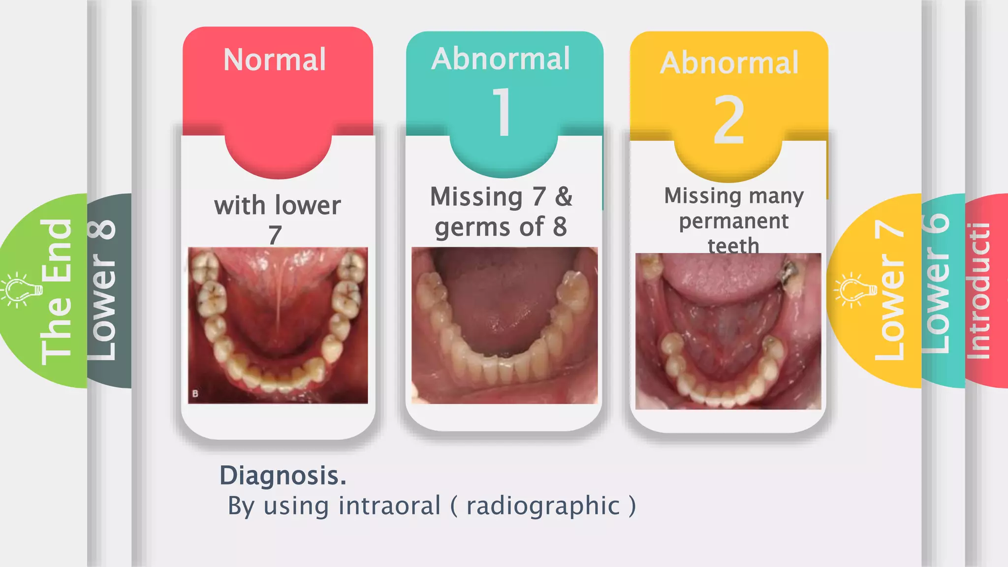 Variation of mandibular molars | PPTX