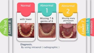 Variation of mandibular molars | PPTX