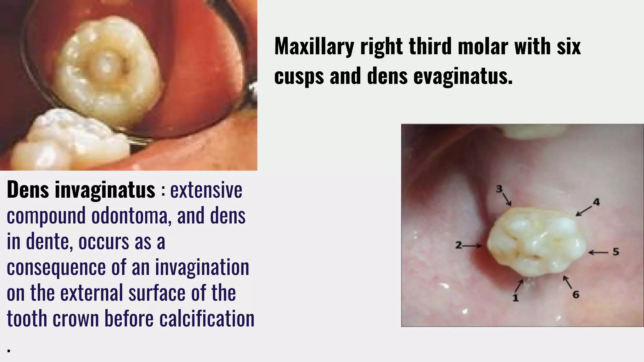 Variation of upper permanent molars | PPTX | Dental Health | Diseases ...