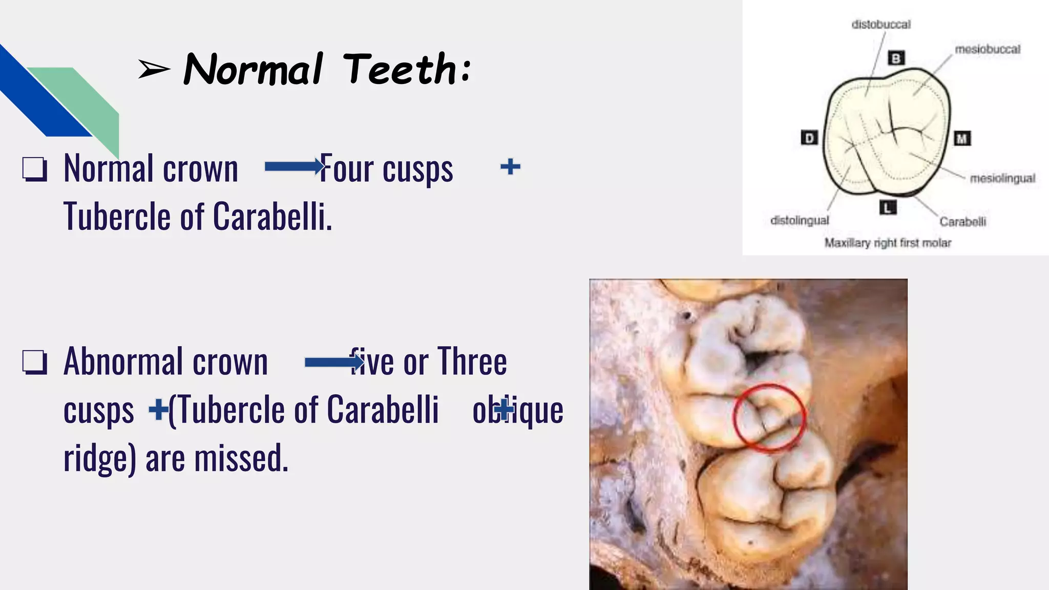 Variation of upper permanent molars | PPTX | Dental Health | Diseases ...