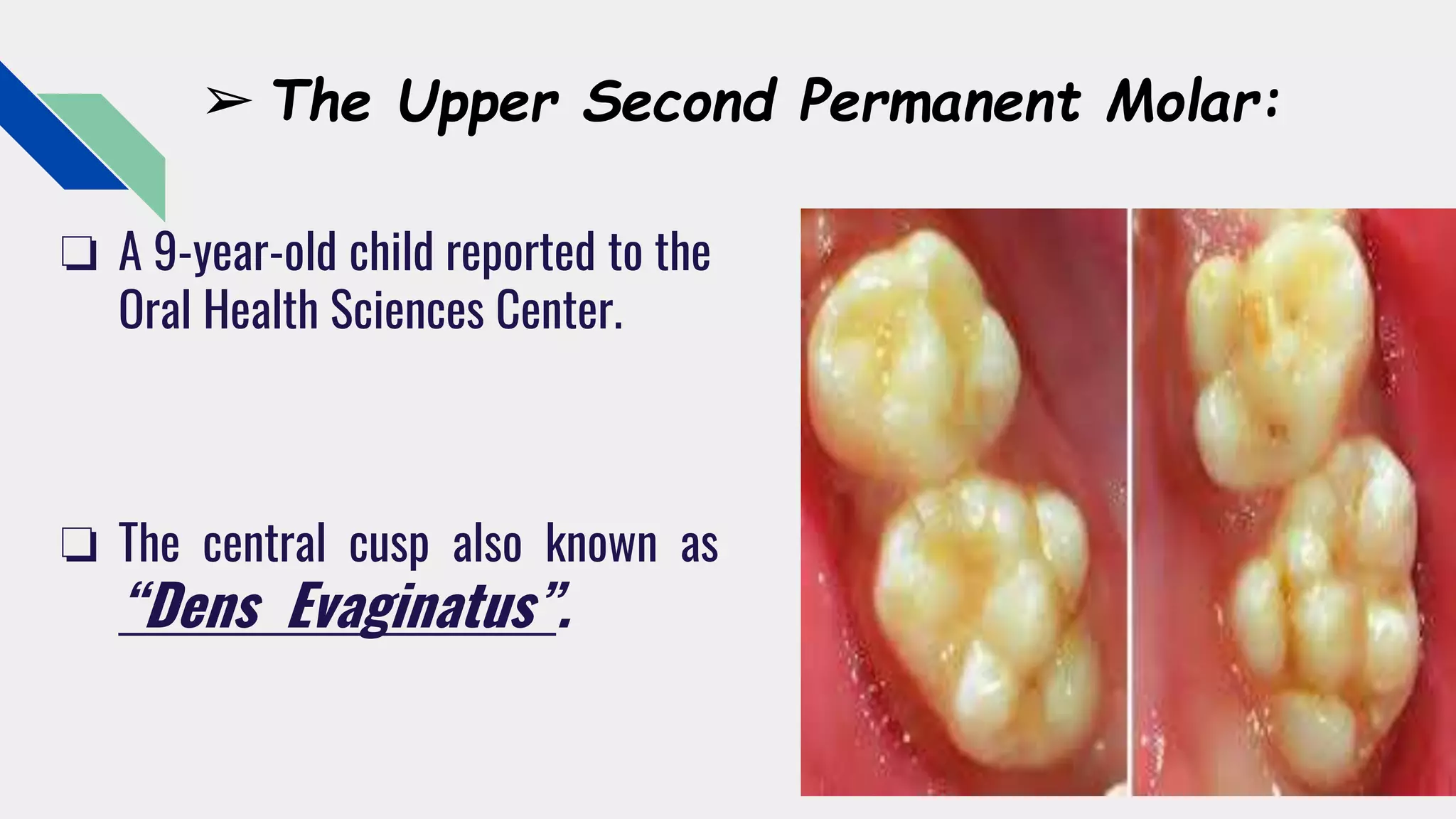 Variation of upper permanent molars | PPTX