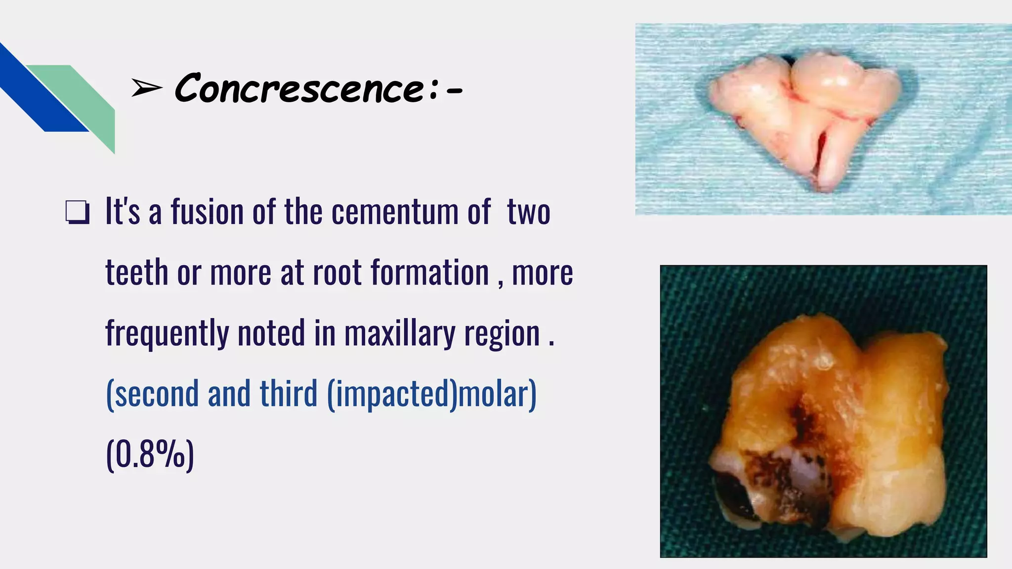 Variation of upper permanent molars | PPTX