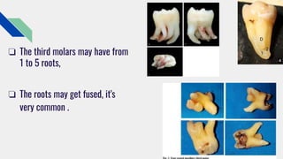 Variation of upper permanent molars | PPTX | Dental Health | Diseases ...