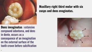 Variation of upper permanent molars | PPTX | Dental Health | Diseases ...