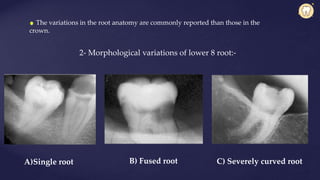 Variations in lower permanent molars | PPTX