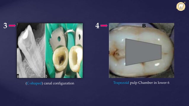 Variations in lower permanent molars | PPT