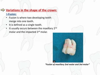 Variations in maxillary molars | PPTX | Dental Health | Diseases and ...