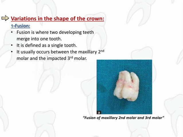 Variations in maxillary molars | PPTX | Dental Health | Diseases and ...