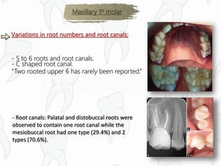 Variations in maxillary molars | PPTX | Dental Health | Diseases and ...