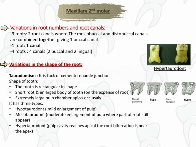Variations in maxillary molars | PPTX | Dental Health | Diseases and ...