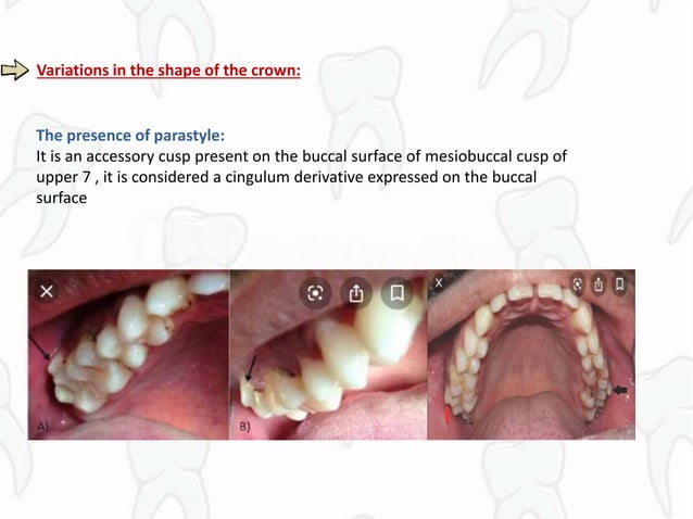 Variations in maxillary molars | PPTX | Dental Health | Diseases and ...