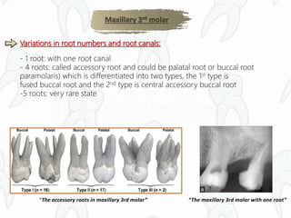 Variations in maxillary molars | PPTX | Dental Health | Diseases and ...