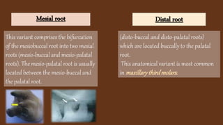 Variations of maxillary molars | PPT