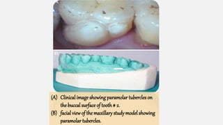 Variations of maxillary molars | PPT