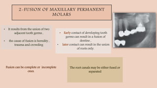 Variations of maxillary molars | PPT