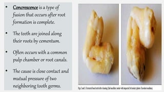 Variations of maxillary molars | PPT