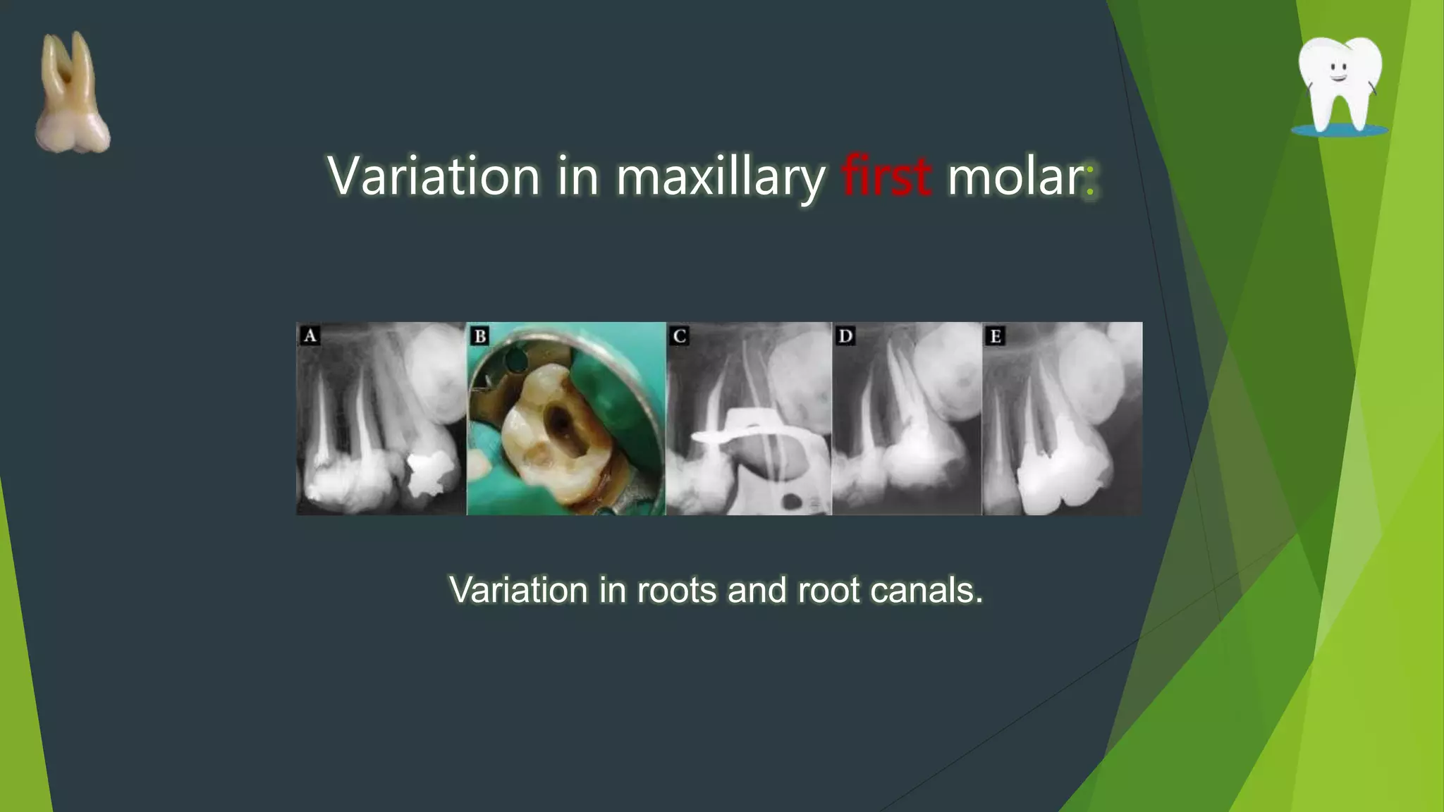 Variations of maxillary molars | PPTX