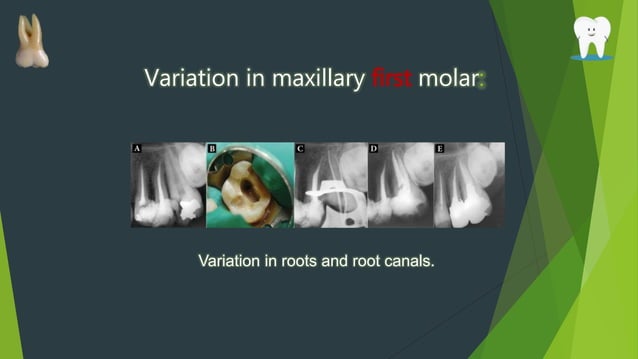 Variations of maxillary molars | PPT