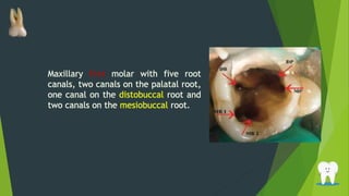 Variations of maxillary molars | PPT
