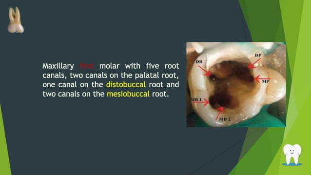 Variations of maxillary molars | PPT