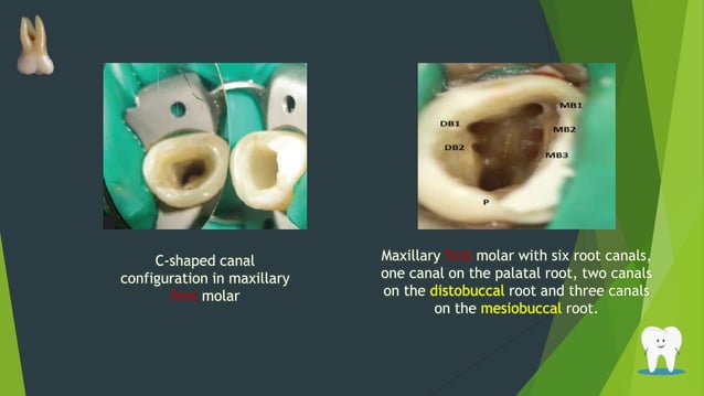 Variations of maxillary molars | PPT