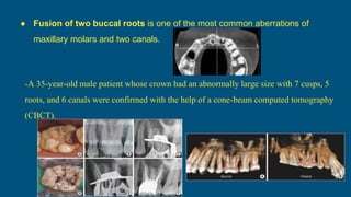 Variations of maxillary permenant molars | PPT