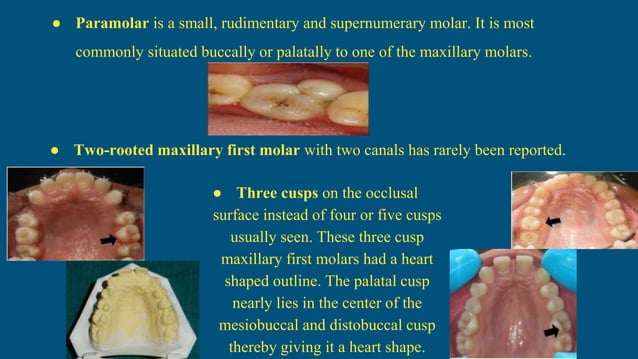 Variations of maxillary permenant molars | PPT