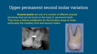 Variations of maxillary permenant molars | PPT