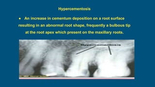 Variations of maxillary permenant molars | PPT