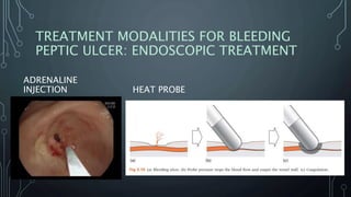 Variceal bleeding and massive upper gi bleeding | PPTX