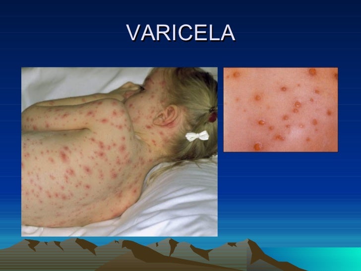 Varicela