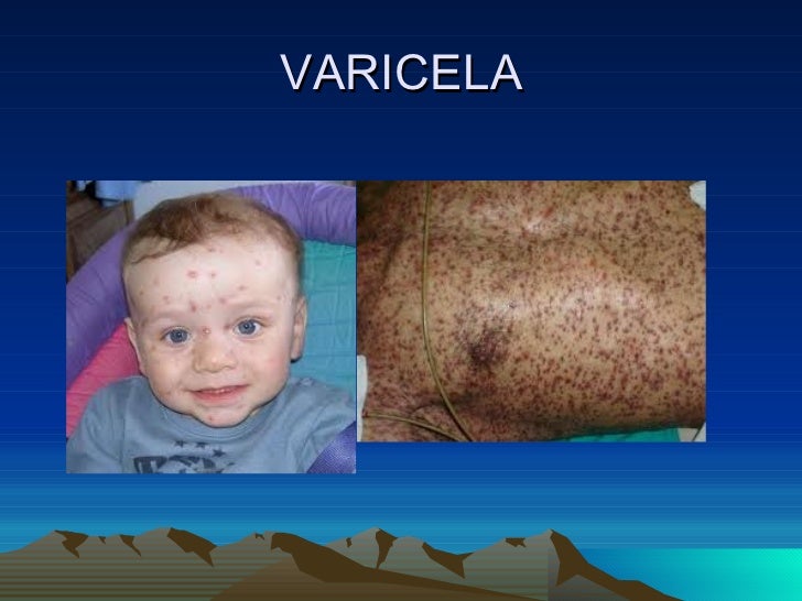 Varicela