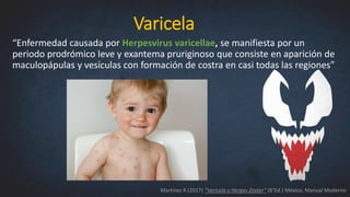 Varicela | PPTX